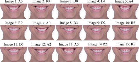 Influence Of Upper Lip Curvature On Smile Attractiveness In Patients With Different Degrees Of