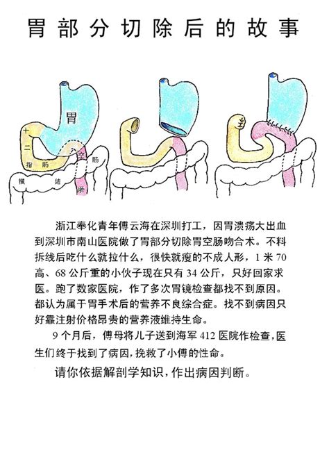 胃部分切除术后的故事 广州市苏密顿教具有限公司