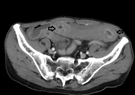 Ct Showing Circumferential Wall Thickening Narrowing Of The Lumen And