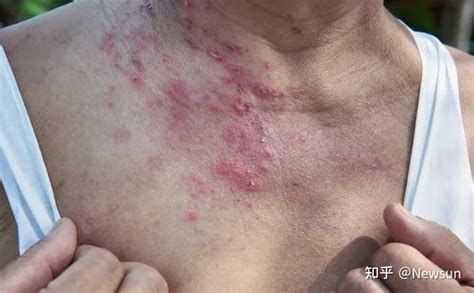 疱疹病毒的种类及症状表现（附图片） 知乎