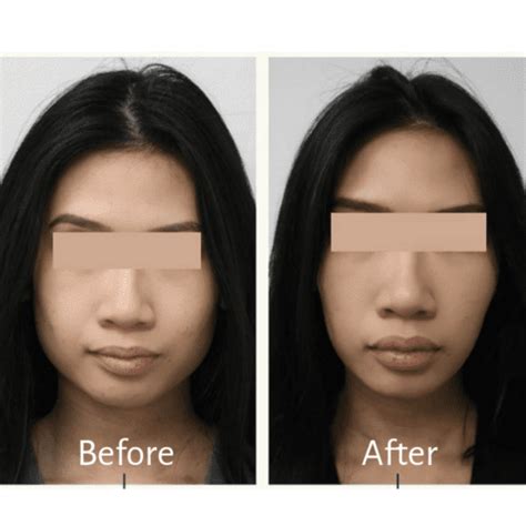 Masseter Botox Gallery Before And After Newbeauty