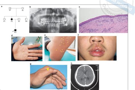 Figure 1 From Novel Ptch1 Mutation Causes Gorlin Goltz Syndrome