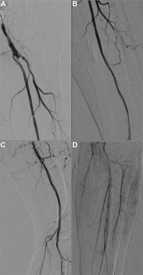 Percutaneous Access Of An Intraoperatively Recanalized Mid Superficial
