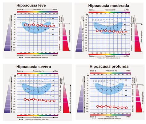 Edgardoaguilarocupacional Audiometrias Utilidad En Las Lesiones Por