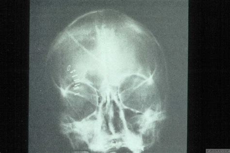 Maxillary Sinus Pptx Dr Wafaa Muhadharaty