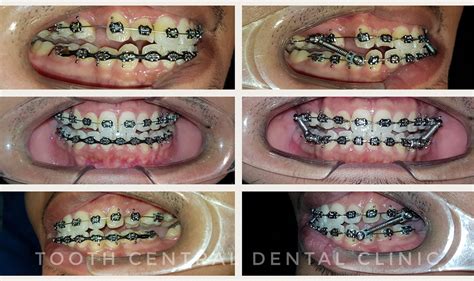 Cs4® Class Ii And Class Iii Tooth Central Dental Clinic Facebook