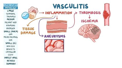 Vasculitis Pathology Review Video And Anatomy Osmosis