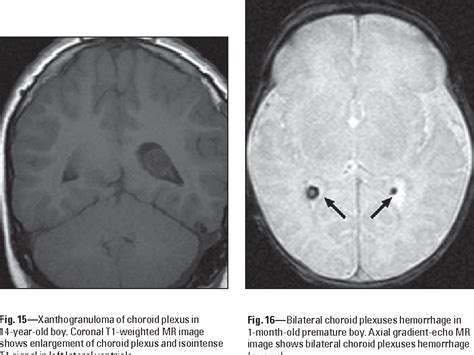 Xanthogranuloma Of The Choroid Plexus Image Xanthogranuloma Of The