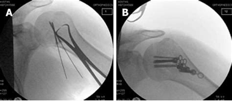 Intra Operative Fluoroscopic Images Initially The Bigger Fragments Of