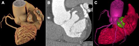Pseudoaneurysm Of The Mitral Aortic Intervalvular Fibrosa Pmc