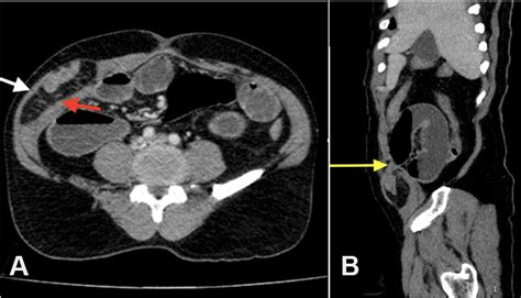 Ct Scan Rug Hernia Ct Scan Machine Hernia Diagnosis Ct Scan Ct Scan