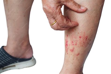 Premium Photo Itching With Atopic Dermatitis Skin Scratching For