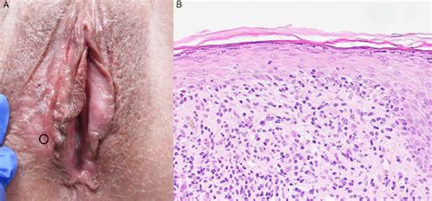 Lichenoid Dermatitis With Clinical Findings Suggestive Of Lichen