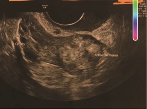 Primary Ovarian Ectopic Pregnancy