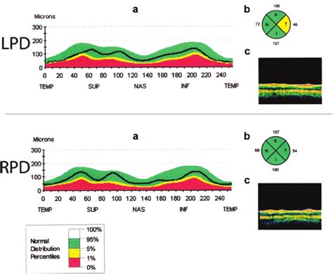 Retinal Nerve Fiber Layer Rnfl Depictions Selected Elements Of An