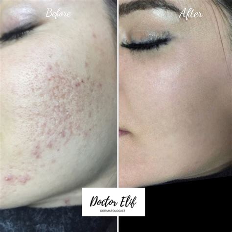 Acne Scar Treatment Dr Elif Clinic