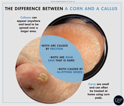 Corn Or Callus How To Tell The Difference Queen St Physio