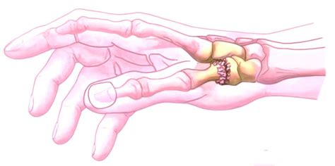 ¿qué Es La Rizartrosis Síntomas Y Tratamiento Eficaz