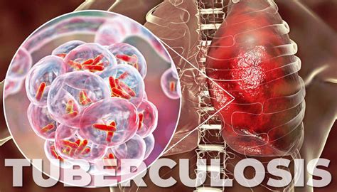 Revelan Tuberculosis Multirresistente Sigue Siendo Una Crisis De Salud