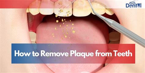How To Remove Plaque From Teeth Arch Dental