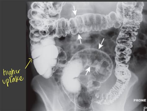 Lecture 9 Common Abdominal And Pelvic Abnormalities Flashcards Quizlet