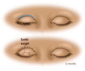 Facial Reanimation ‣ Reconstructive Surgery ‣ Thanc Guide