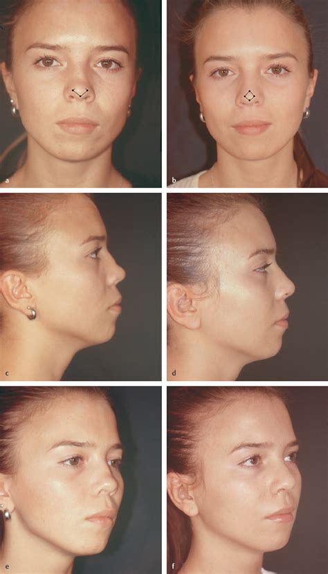 Congenital Syphilis Saddle Nose