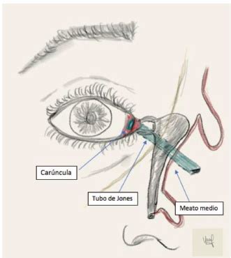 Dacriocistorrinostomía Externa Conjuntivo Dacriocistorrinostomía Y