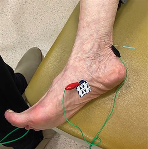 Refractory Overactive Bladder Obgyn Key