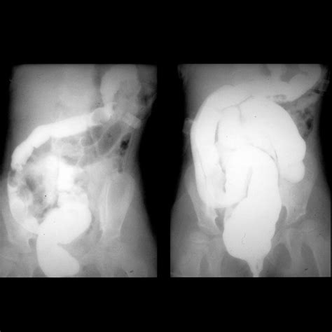 Colonic Duplication Pediatric Radiology Reference Article Pediatric
