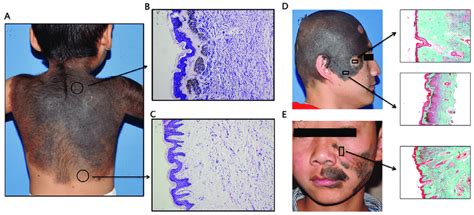 A Large Giant Congenital Melanocytic Nevi Lesion On The Back Of A