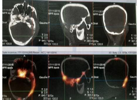 Spect Ct Technetium 99 Of The Temporal Bone Showing High Tissue