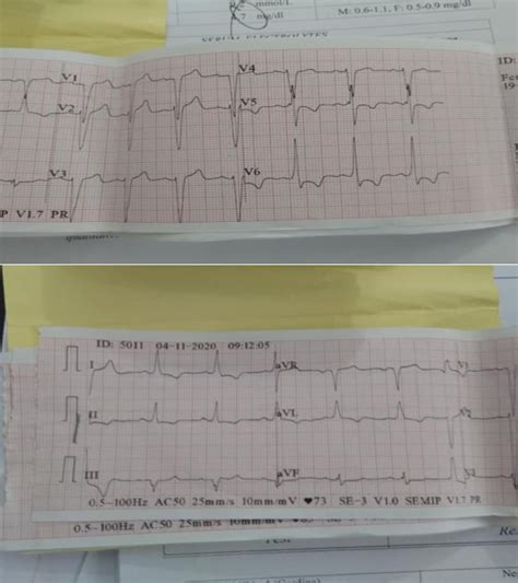 Figure 4 From Left Ventricular Noncompaction Cardiomyopathy Lvnc A