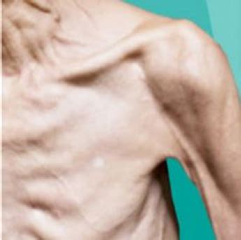 Sarcopenia