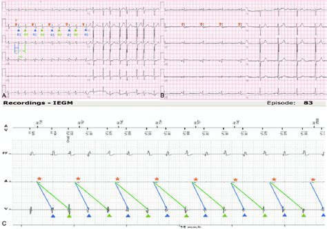 Surface Electrocardiogram And Iegm From Icd Programmer 25 Mms 10