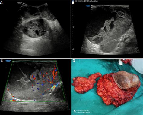 Phyllode Tumor