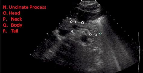 Urr Part 4 Pancreas And Spleen Flashcards Quizlet