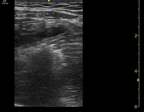 Pocus To Rule In Appendicitis Prior To Ct Imaging