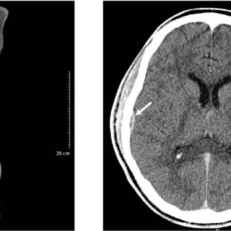 Ct Radiography Of The Chest Abdomen Pelvis Head Spine Showing