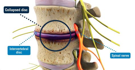Collapsed Disc 3d Render Spine Surgery Spinal Nerve Intervertebral Disc