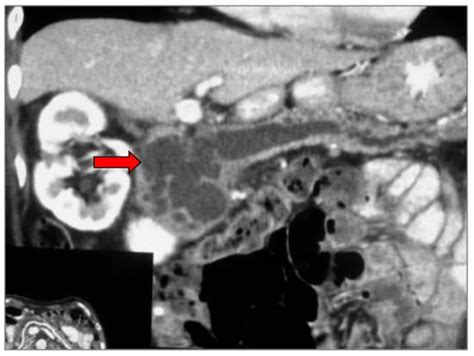 Intraductal Papillary Mucinous Neoplasm of the Pancreas: A Challenging Diagnosis