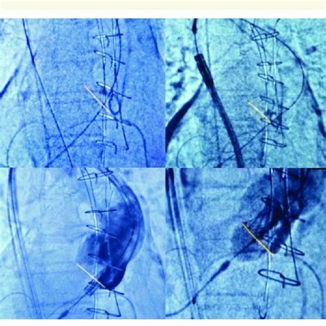 Per Procedural Images With Calcification Enhancement And Aortic Annulus