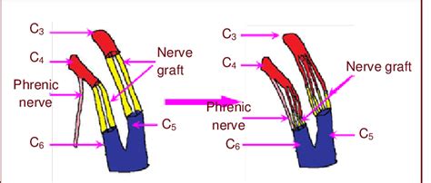 C3 And C4 Phrenic Nerve Transfer For Treatment Of C5 6 Root Avulsion
