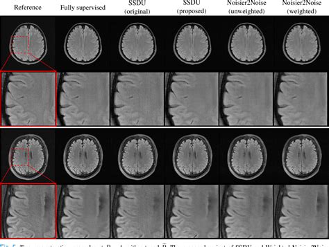 Figure 1 From Self Supervised Deep Learning Mri Reconstruction With