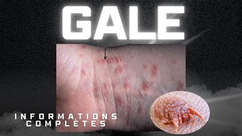 La Gale Expliquée Symptômes Causes Traitement Et Prévention Youtube