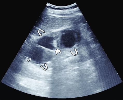 Ultrasound Image Shows Multiple Cystic Lesions Curved Arrows In The