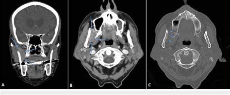 Masticatory Space Metastasis A B Ct Scan Of The Neck Showing A Mass Download Scientific