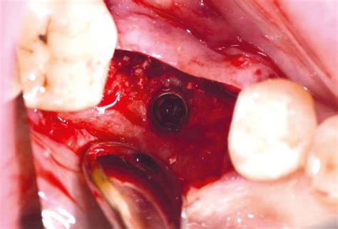 Bone Defect Augmentation In The Lower Jaw Using Autologous Bone