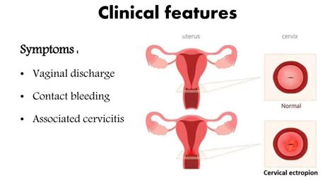 Dne 212 Cervical Ectropion Cervical Erosion Nurses Online Discussion
