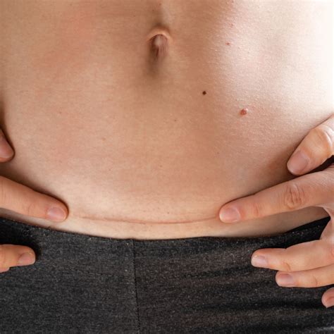 Things To Know About Tummy Tuck Surgery Terris Little Haven